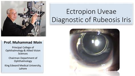 Ectropion Uveae Diagnostic Feature Of Rubeotic Glaucoma Youtube