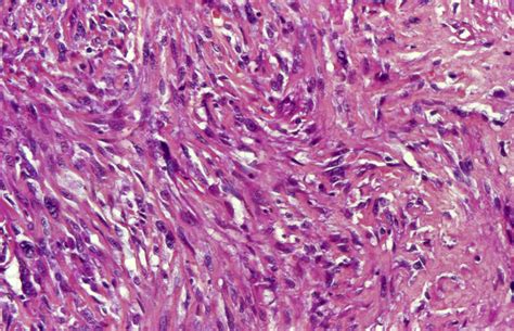 Fibrosarcoma Light Micrograph Stock Image C0601170 Science