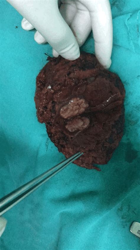 Segmentectomy Material With Liver Segment 6 Located Colorectal Cancer Download Scientific