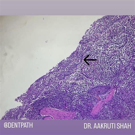 Dr Aakruti Shah On Linkedin Patterns In Pathology One Of The Most