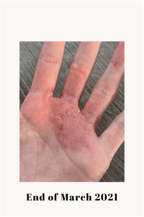 My Experience With Dyshidrotic Eczema Pompholyx