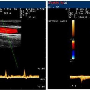 Example Of Common Carotid Artery Examination With Cd And Pw Left