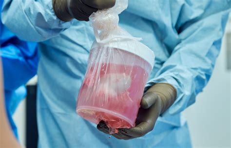 刷新纪录！又一例猪肾移植公布，已持续工作 32 天腾讯新闻