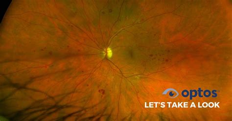 Type 1 And 2 Diabetes Eye Exams In Edmonton