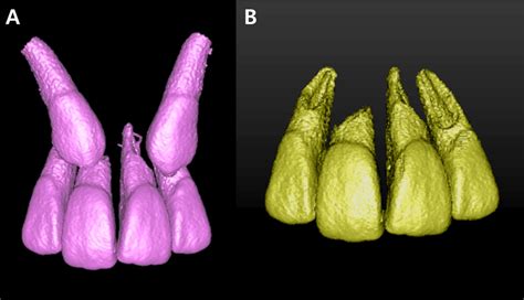 The Aspect Of Impaction And Root Resorption Using A 3d Simulation