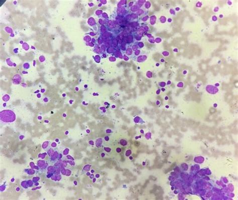 Fine Needle Aspiration Cytology Of Cervical Lymph Node Showing Download Scientific Diagram