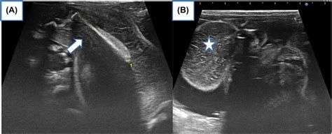 A B Postnatal Ultrasound Of The Newborn Shows Show Heterogeneously