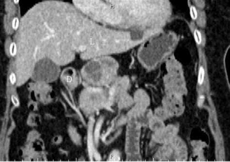 Computed Tomography Findings A Mass Was Between The Duodenum D And