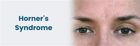Horners Syndrome Sababu Dalili Na Utambuzi