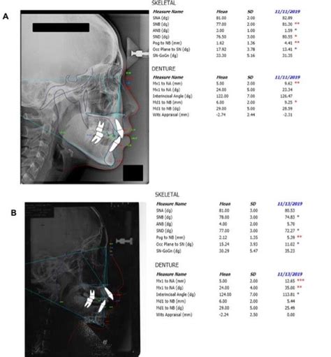 Cephalometry Analysis For Skeletal Malocclusion Diagnosis Class I Anb