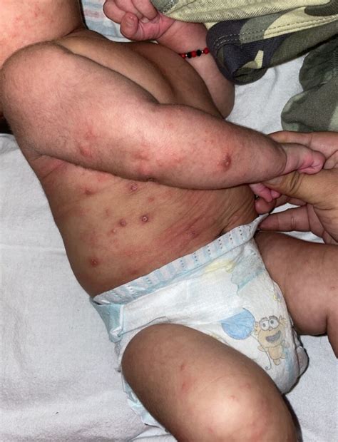 Diffuse Rash In Newborn Clinical Advisor