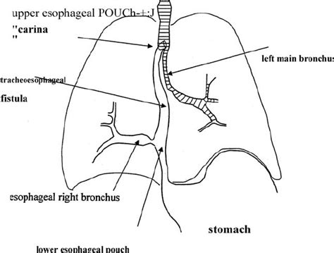 Schematic Drawing Of The Pathologic Anatomy Download Scientific Diagram