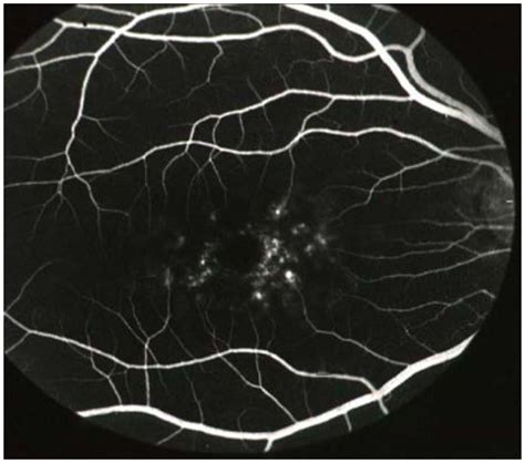 Fluorescein Angiogram Illustrating The Dark Silent Choroid Absence