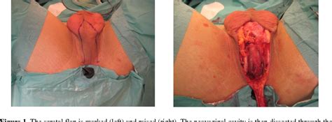 Transgender Genital Surgery Before And After