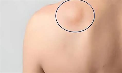 Concienciación Sobre El Sarcoma Un Tipo De Cáncer Poco Frecuente Pero