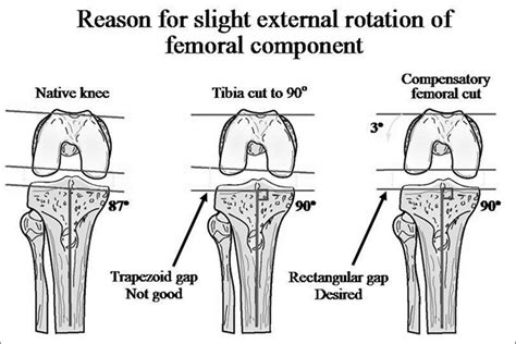 Tka Patellofemoral Alignment Recon