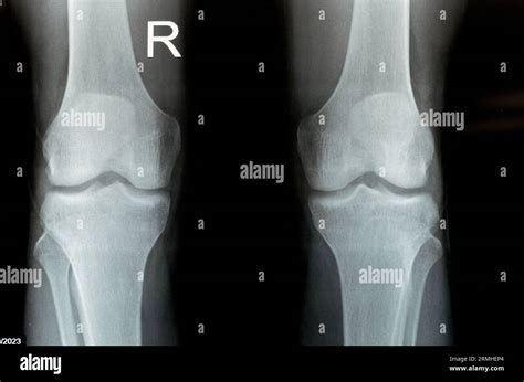 Plain X Ray Of Both Right And Left Knee Joints With Lower Part Of Femur And Upper Parts Of Tibia
