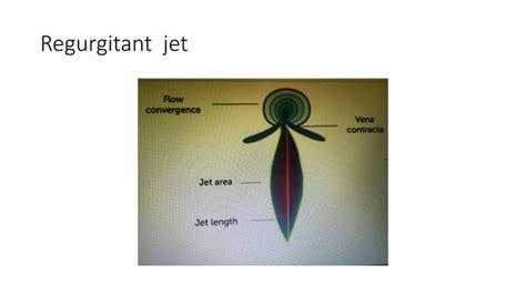 Echo Mitral Regurgitation 1pptx