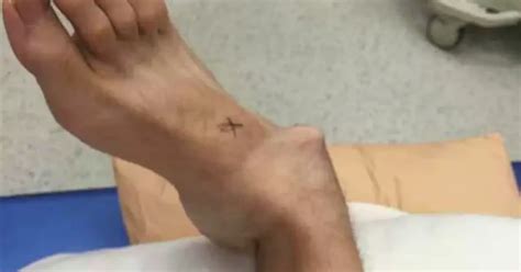 Ankle Dislocation Symptoms Causes And Treatments