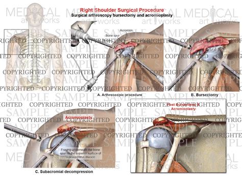 Right Arthroscopic Surgery Bursectomy And Acromioplasty Medical Art Works