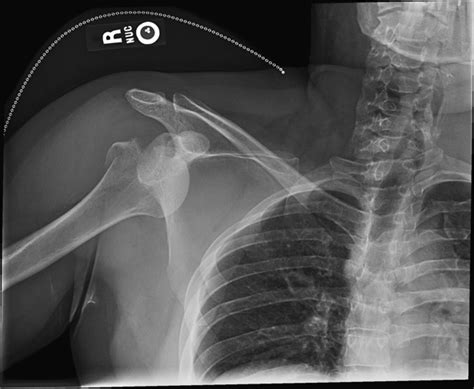 Anteroposterior Radiograph Of The Right Shoulder Showing A Glenohumeral