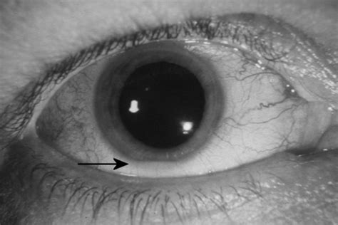 Hypopyon Anterior Segment Photograph Of Right Eye Showing Hypopyon At