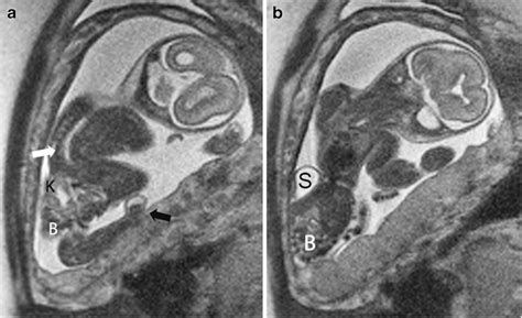 Limbbody Wall Defect In A 20 Week Fetus Single Shot Turbo Spin Echo