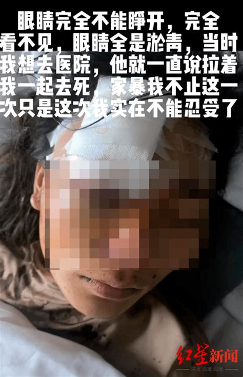 网友爆料姐姐被姐夫家暴入院,警方介入:伤情鉴定后将采取进一步措施伤者右眼皮肤 网友爆料姐姐被姐夫家暴入院,警方介入:伤情鉴定后将采取进一步措施伤者右眼皮肤