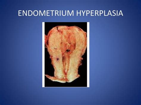 Hyperplasia Pptx Endocrine And Metabolic Diseases Diseases And