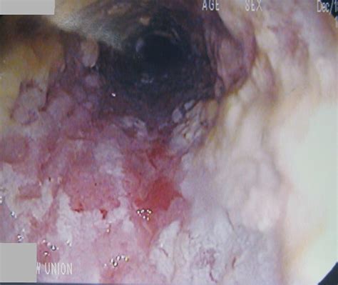 칸디다 식도염 Candida Esophagitis 의학당