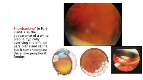 Uveitits Classifications And Approach Pptx