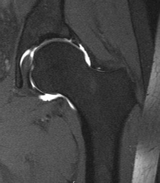 Hip Impingement