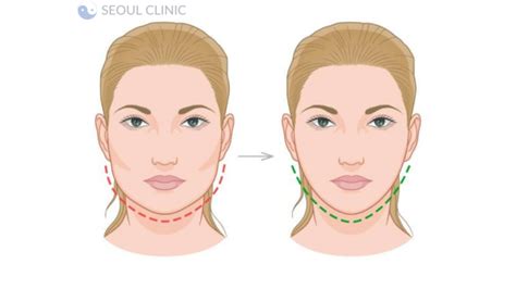 Jaw Reduction In Korea Cost Clinics And More June 2024