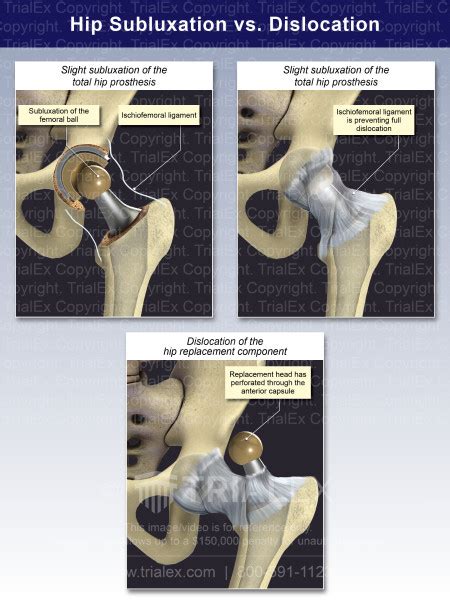 Hip Subluxation Vs Dislocation Trialquest Inc