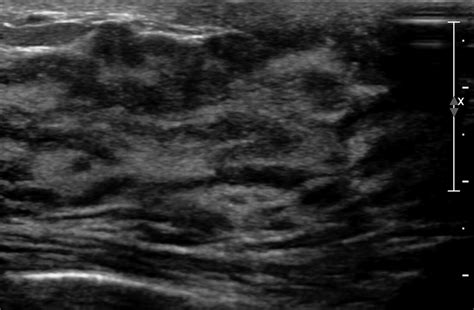 Breast Imaging Of The Pregnant And Lactating Patient Physiologic