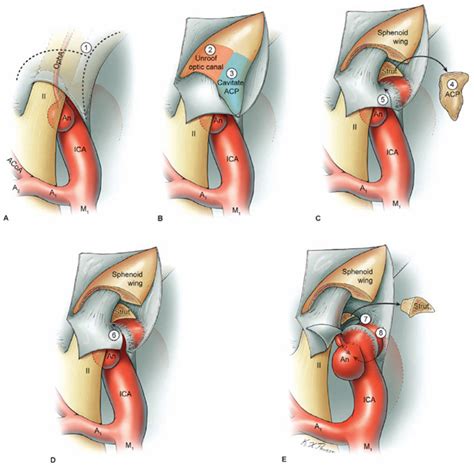 Ophthalmic Artery Aneurysms Neupsy Key