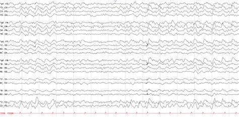 Normal Eeg Tracing
