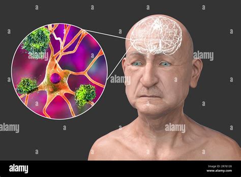 Plaques Brain Function At Kari Gonzales Blog