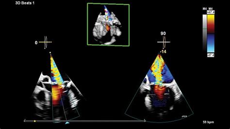 Launch Of Transcend Plus Ultrasound At Esc Philips
