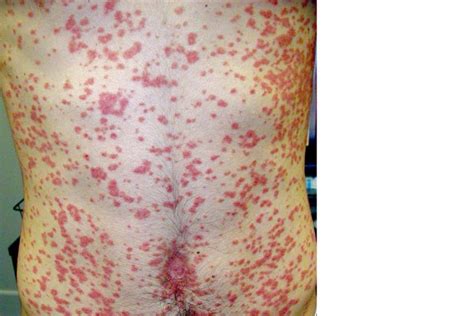 Pruritic Papular Eruption