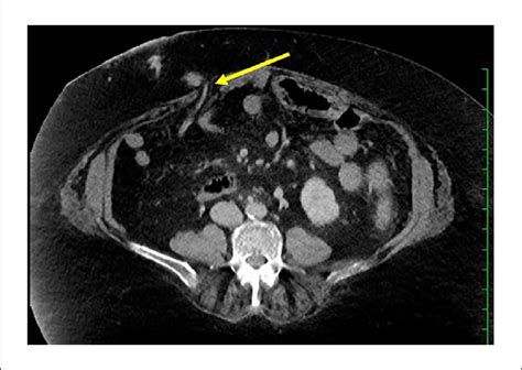 Transverse Computed Tomography Angiogram Of The Abdomen Demonstrates