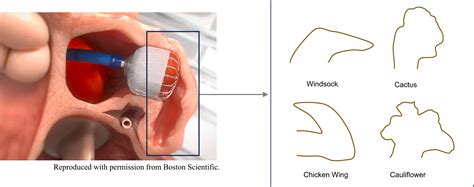 Current Evidence And Indications For Left Atrial Appendage Closure