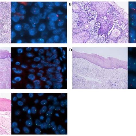 X And Y Chromosomes In Tumor Tissues Identified By Microdissection Pcr