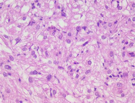 The Neoplastic Cells Are Organized In Small Bundles The Cells Are