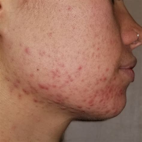 Solution Ac Deficiency Heat Stasis Herbal Supplement — Cmd Skin Solutions