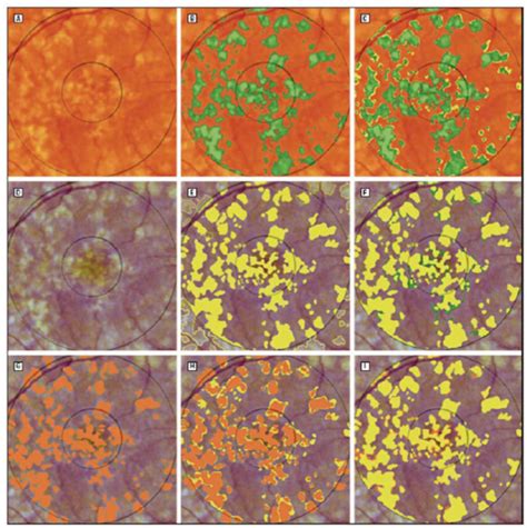 comparison of drusen segmentation by the interactive method vs 2