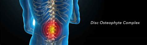 Discosteophytecomplex Bonati Spine Institute