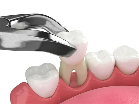 What Are The Stages Of Healing After A Tooth Extraction Abba Dental