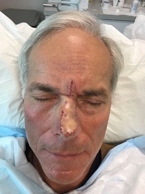 Nose Acms American College Of Mohs Surgery