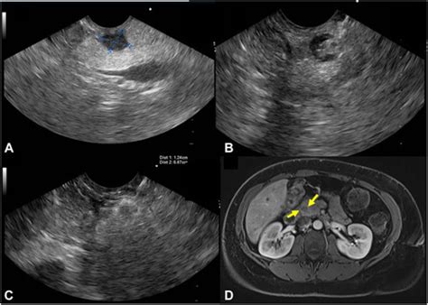 Tumor Enhancement By Magnetic Resonance Imaging After Endoscopic